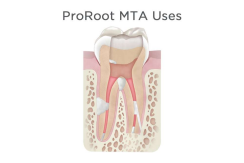 ProRoot MTA Root Repair Delivery System