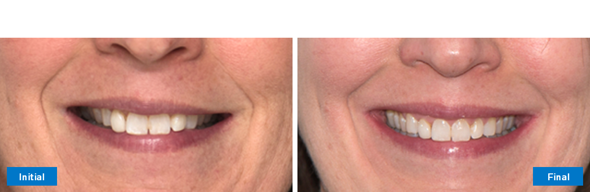 Leichter Fall, Klasse II – Schmale Bögen (SureSmile® Aligner) Deutschland