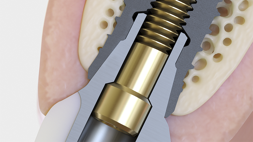 DS OmniTaper-Implantatsystem EV | Dentsply Sirona Deutschland
