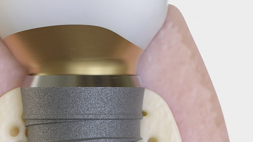 DS OmniTaper-Implantatsystem EV | Dentsply Sirona Deutschland