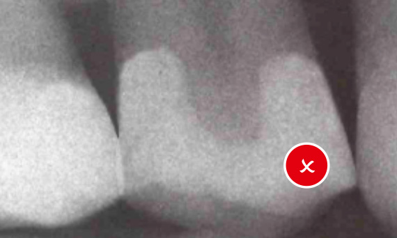 Palodent 360: Vollmatrizensystem | Dentsply Sirona Deutschland