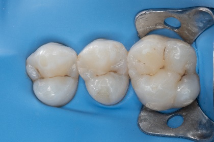 Efficient Direct Restoration of Multiple Cavities in One Upper Quadrant ...