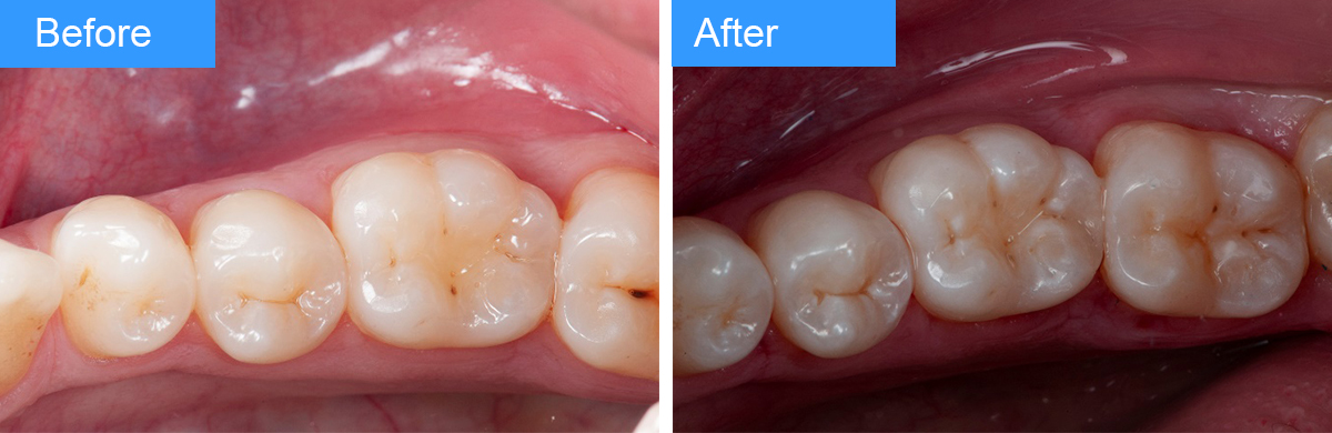 Replacing Class II with Recurrent Caries | Dentsply Sirona MENA