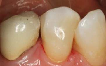 Neo Spectra® ST Flow | Dentsply Sirona MENA