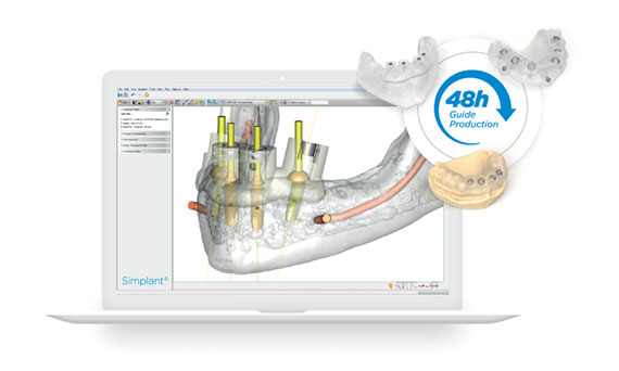 Simplant Implant Planning Software | Dentsply Sirona MENA