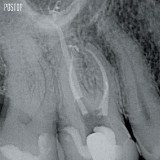 TruNatomy Endodontic Files | Dentsply Sirona MENA