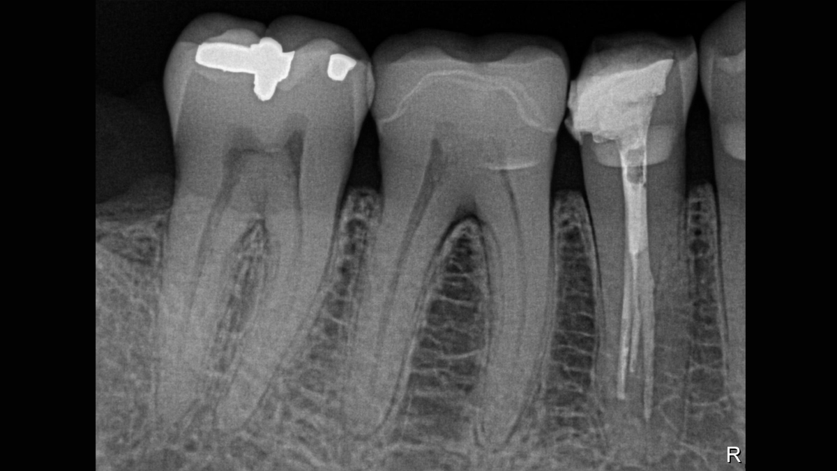Xios XG Supreme Intraoral Sensor | Dentsply Sirona MENA