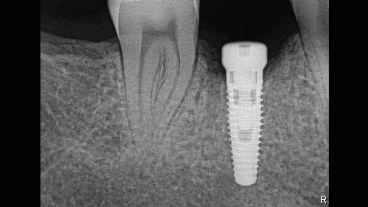 Xios XG Supreme Intraoral Sensor | Dentsply Sirona MENA