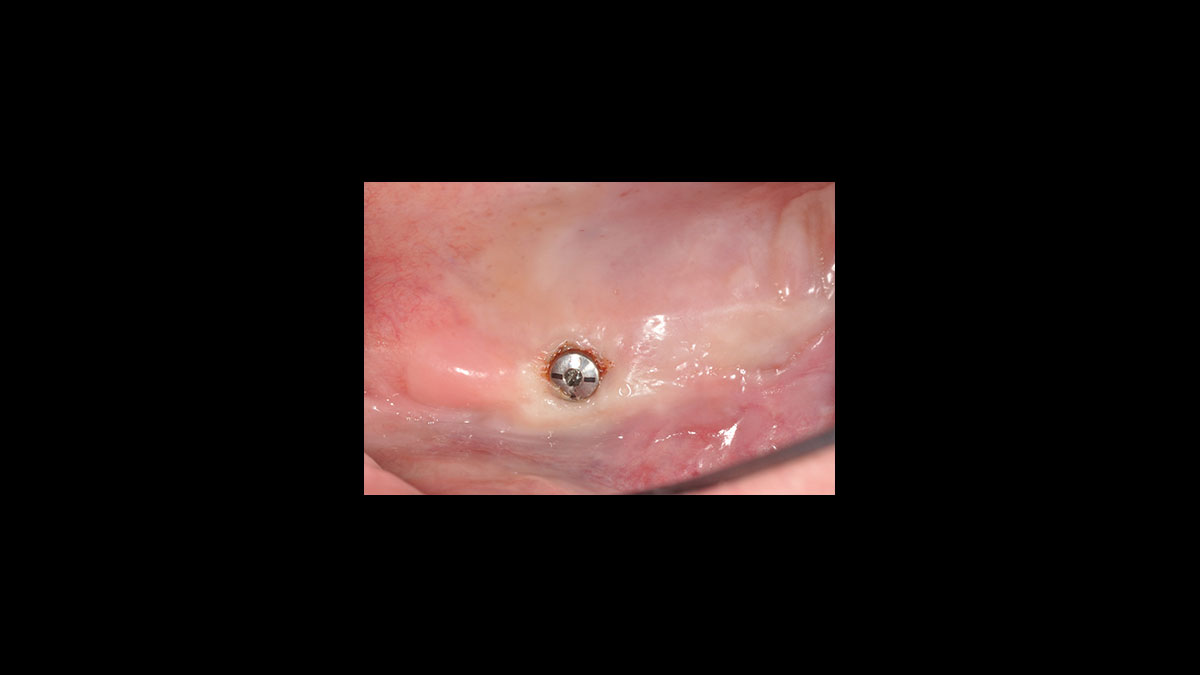 Diode Laser Treatment Videos | Dentsply Sirona MENA