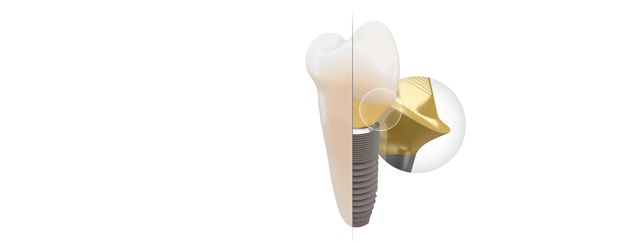 Atlantis Dental Abutments | Dentsply Sirona