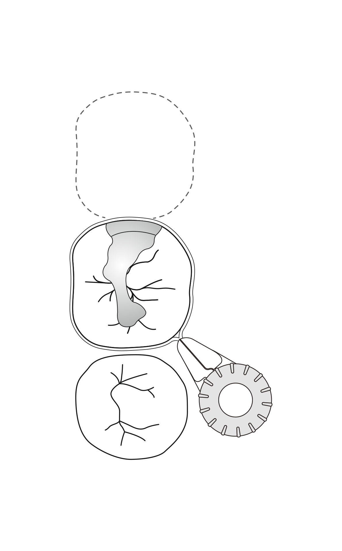Palodent 360: Circumferential Matrix System | Dentsply Sirona Albania