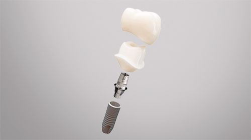 CEREC Implantology: Discover now! | Dentsply Sirona Albania