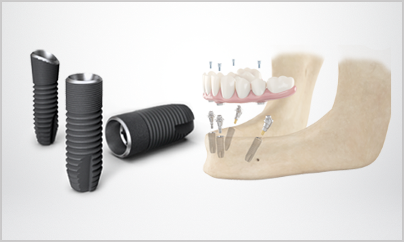 SmartFix Implant Treatment Concept | Dentsply Sirona Albania