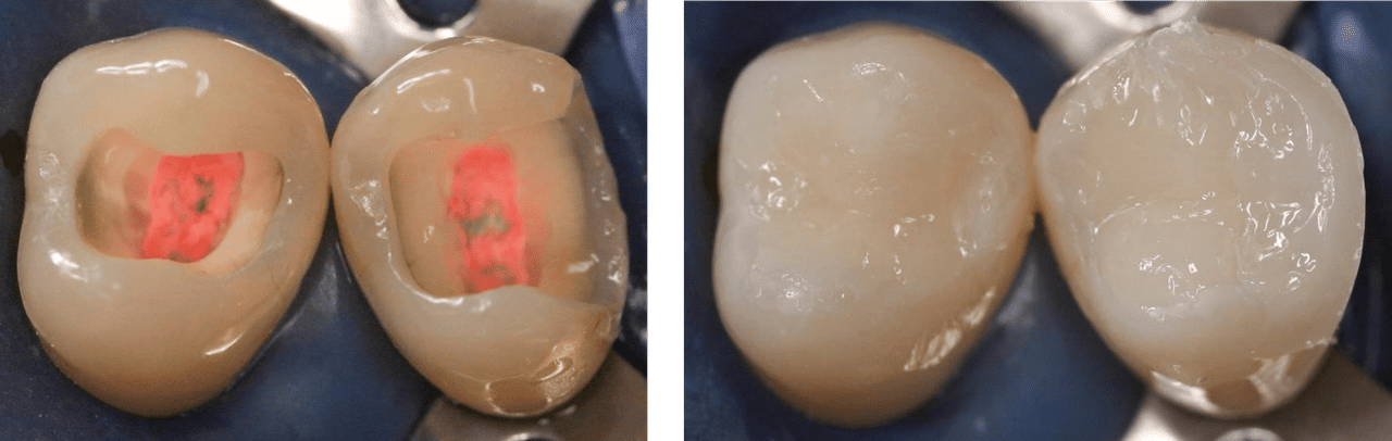 Direct post-endodontic restorations with a tight seal | Dentsply Sirona