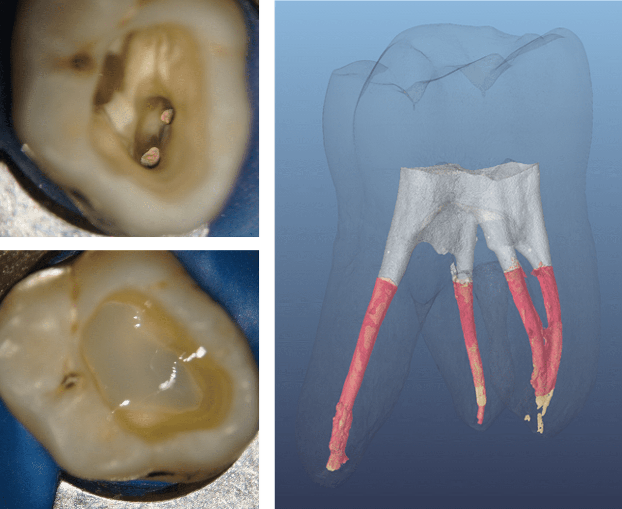 Direct post-endodontic restorations with a tight seal | Dentsply Sirona