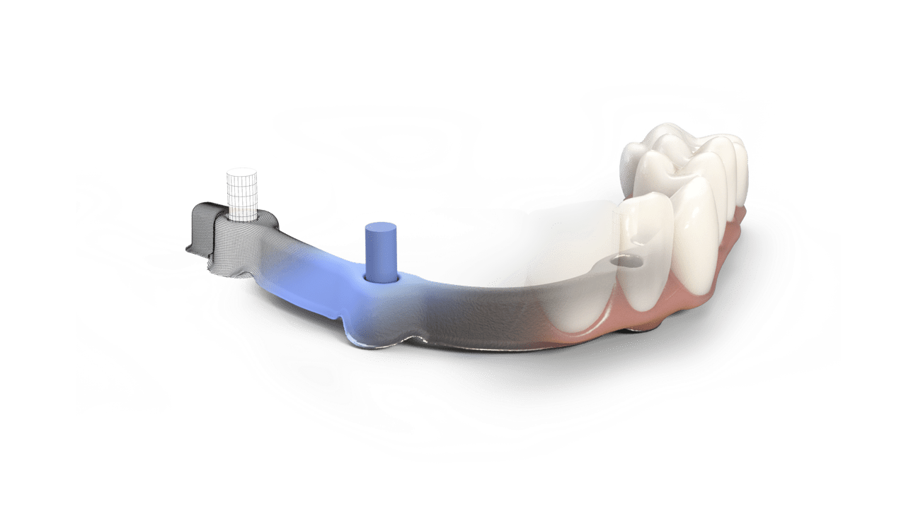 Atlantis Suprastructures | Dentsply Sirona Australia