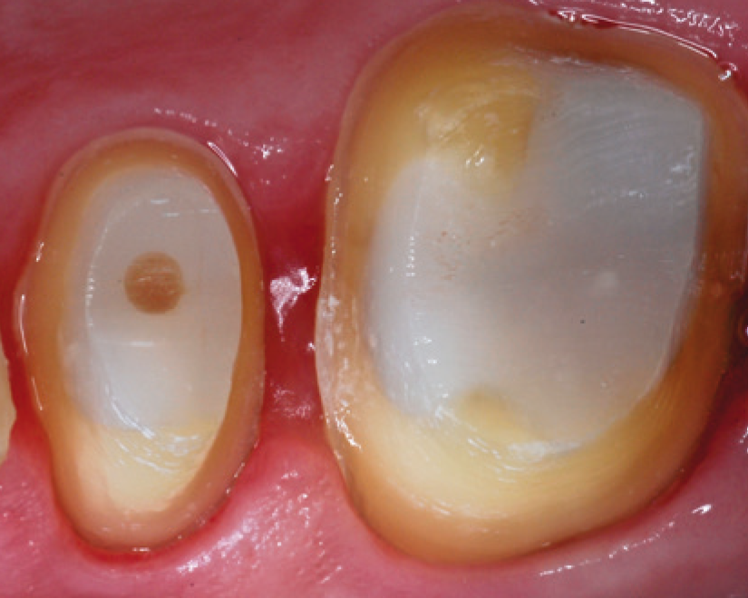 SDR Plus: Bulk Fill Flowable Composite | Dentsply Sirona
