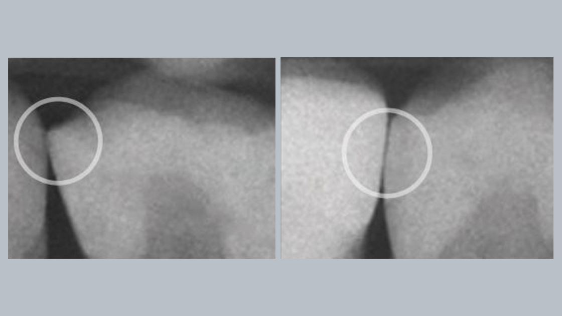 Guide to Class II Restoration Procedures | Dentsply Sirona Bosnia