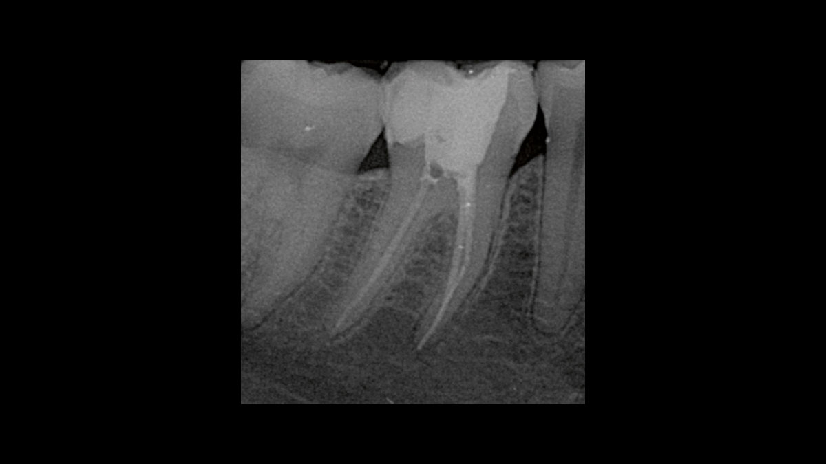 Diode Laser Treatment Videos | Dentsply Sirona Canada