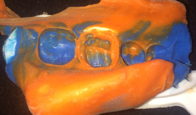 Dental Impressions | Dentsply Sirona DK