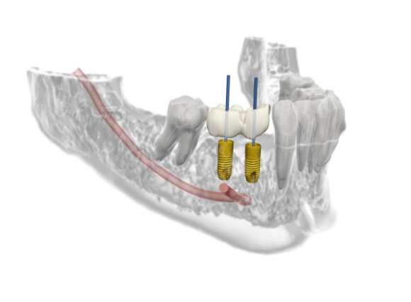 Introduction to Implant Dentistry | Dentsply Sirona UK
