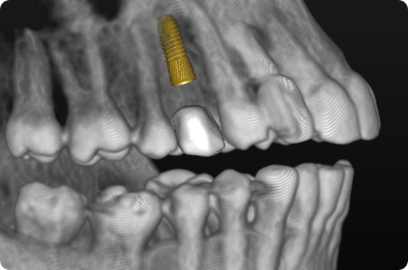 Posterior Single-Tooth Implant Procedures | Dentsply Sirona UK