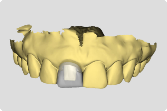 Anterior Single-Tooth Implant Procedures | Dentsply Sirona UK