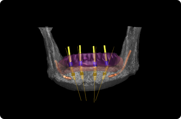 Full-Arch Implant Overdentures | Dentsply Sirona UK