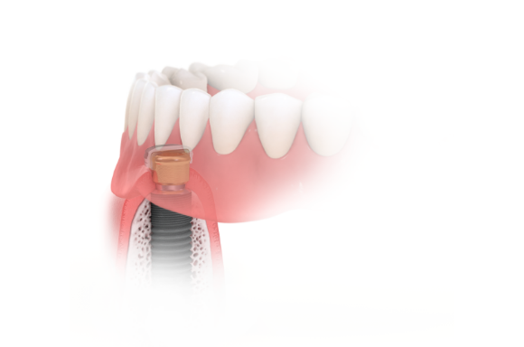 Full-Arch Implant Overdentures | Dentsply Sirona UK