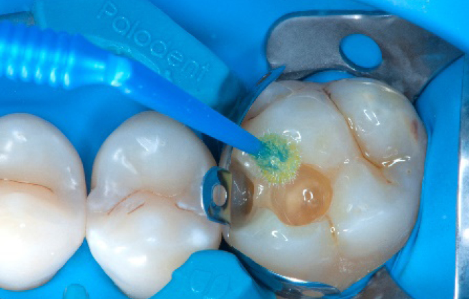 Distal Occlusal Restoration in Asymptomatic Patient | Dentsply Sirona UK
