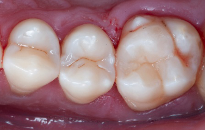 Distal Occlusal Restoration in Asymptomatic Patient | Dentsply Sirona UK