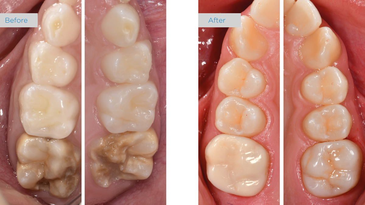 MIH Teeth Treatment: CEREC Tessera Restoration | Dentsply Sirona UK
