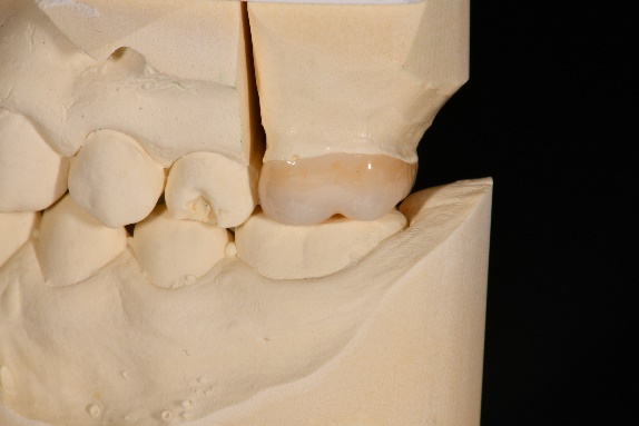 MIH Teeth Treatment: CEREC Tessera Restoration | Dentsply Sirona UK