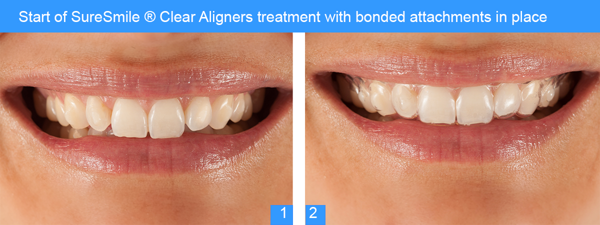 SureSmile Attachment Bonding with Ceram.x Spectra® ST | Dentsply Sirona UK