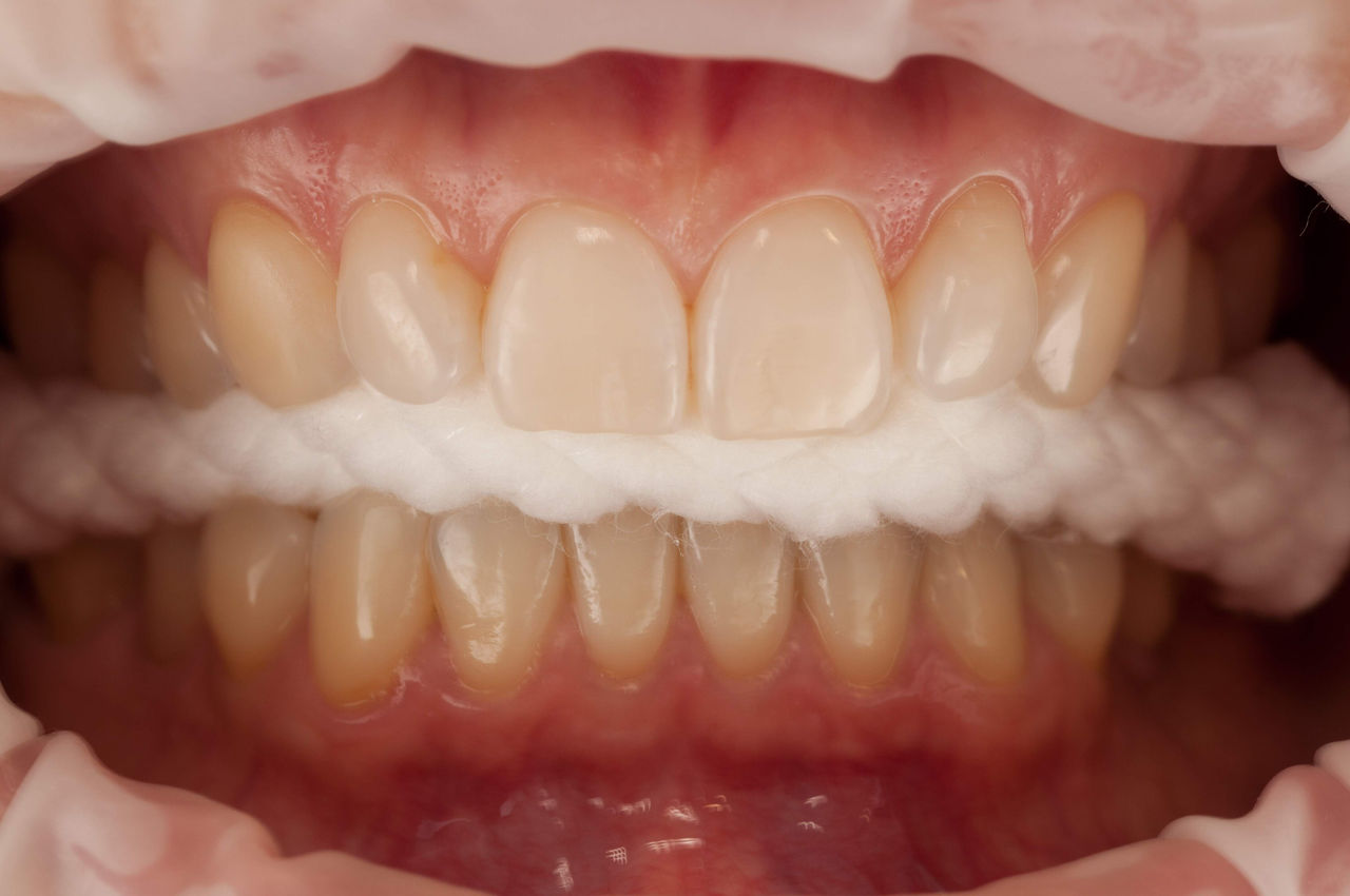 SureSmile Attachment Bonding with Ceram.x Spectra® ST | Dentsply Sirona UK