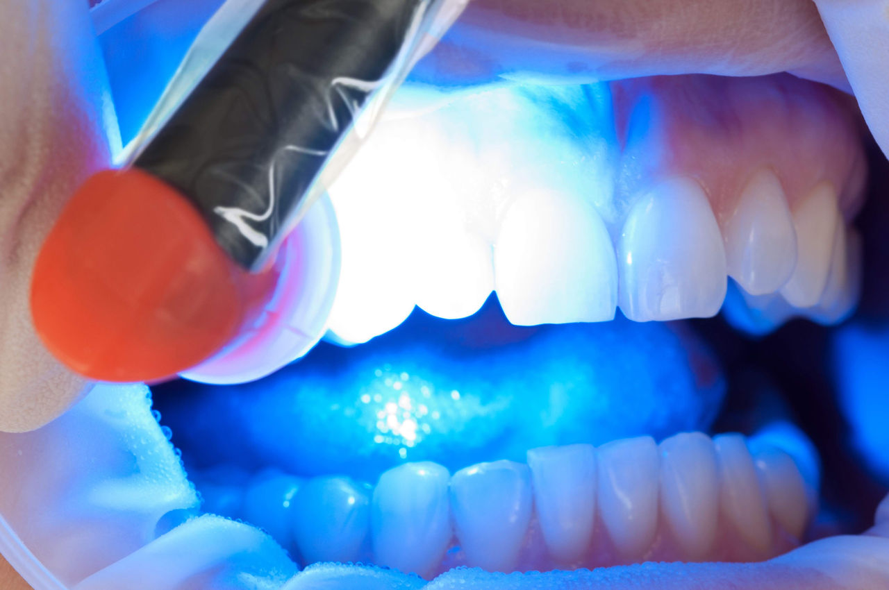 SureSmile Attachment Bonding with Ceram.x Spectra® ST | Dentsply Sirona UK