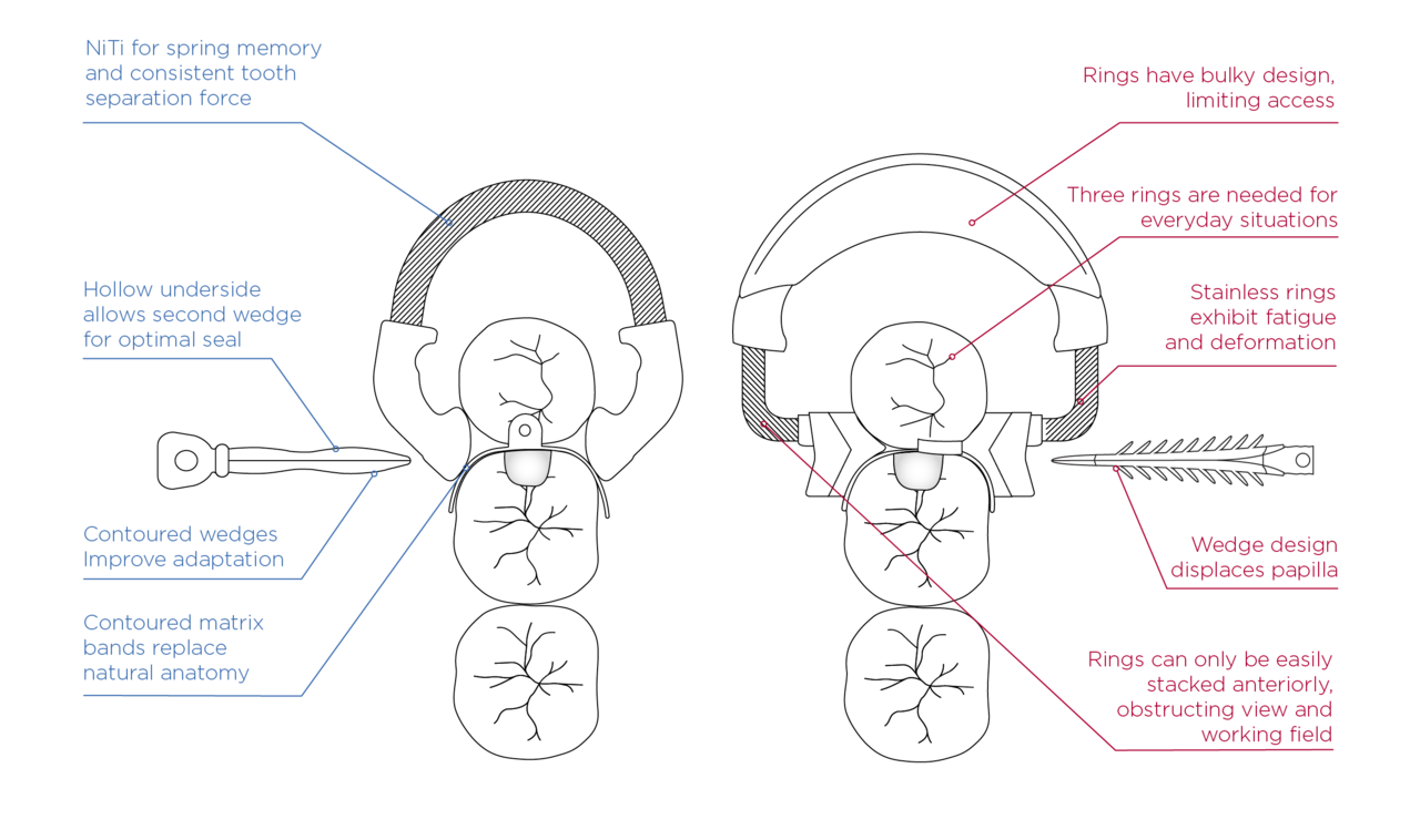 Palodent V3: Sectional Matrix System | Dentsply Sirona UK