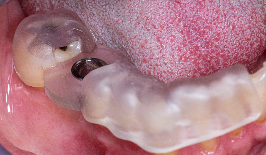 Primeprint Clinical Cases | Dentsply Sirona UK