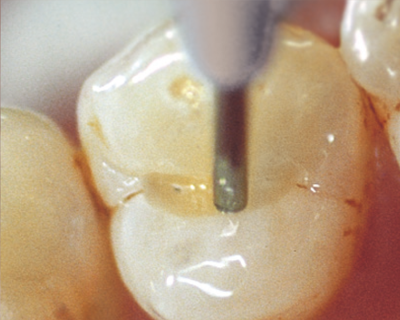 SDR® flow+: Bulk Fill Flowable Composite | Dentsply Sirona UK
