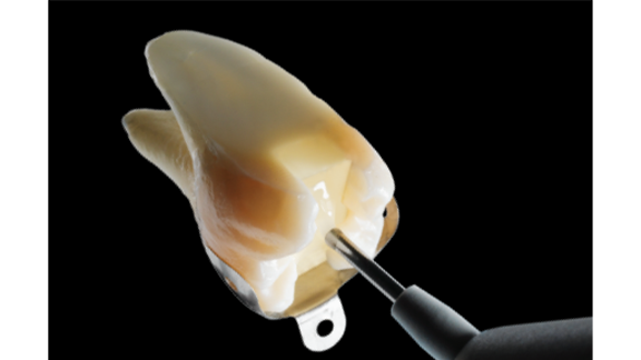 SDR® flow+: Bulk Fill Flowable Composite | Dentsply Sirona UK