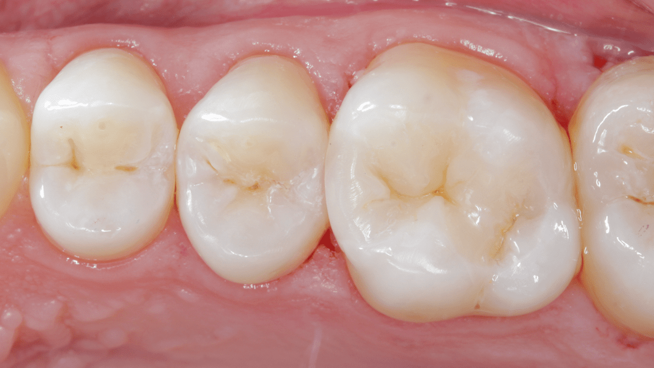Class II Dental Cases | Dentsply Sirona UK