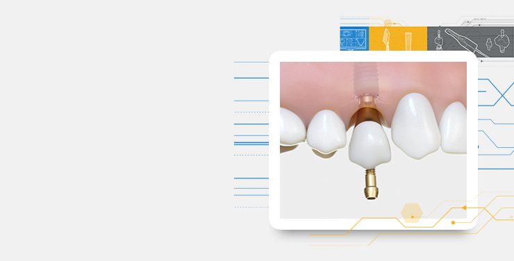 Partial Tooth Replacement Workflow | Dentsply Sirona UK