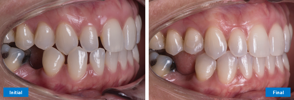 Mild Class 3 Malocclusion: SureSmile Case Study | Dentsply Sirona Hong Kong