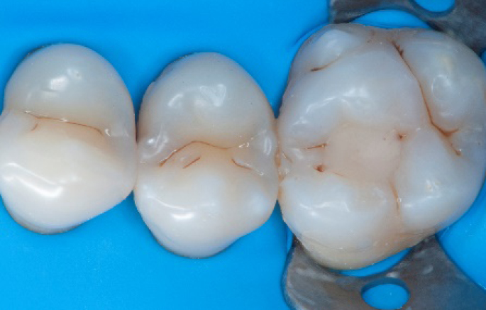 Distal Occlusal Restoration in Asymptomatic Patient | Dentsply Sirona ...