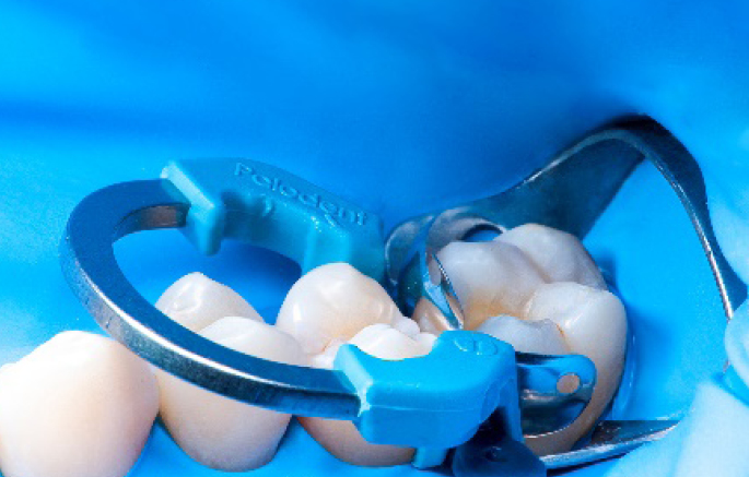 Distal Occlusal Restoration in Asymptomatic Patient | Dentsply Sirona ...