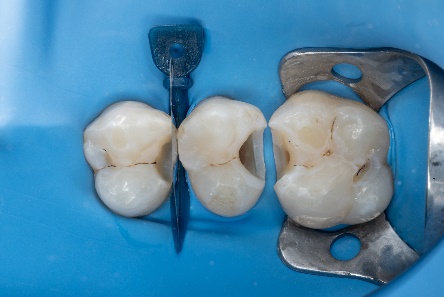 Efficient Direct Restoration of Multiple Cavities in One Upper Quadrant ...
