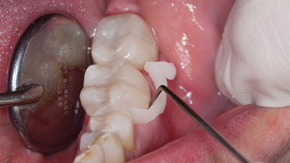 Calibra Ceram: Adhesive Resin Cement | Dentsply Sirona