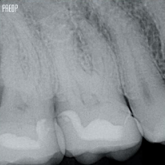 TruNatomy Endodontic Files | Dentsply Sirona