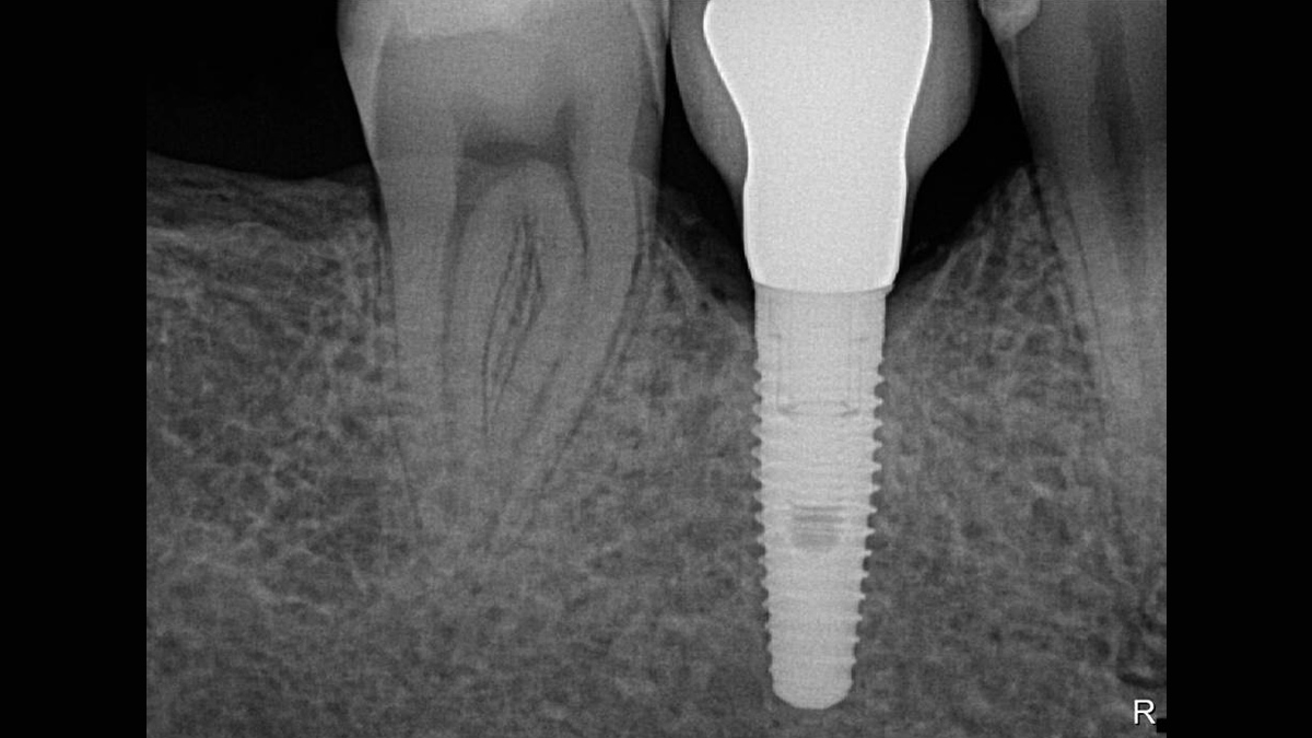 Xios XG Supreme Intraoral Sensor | Dentsply Sirona