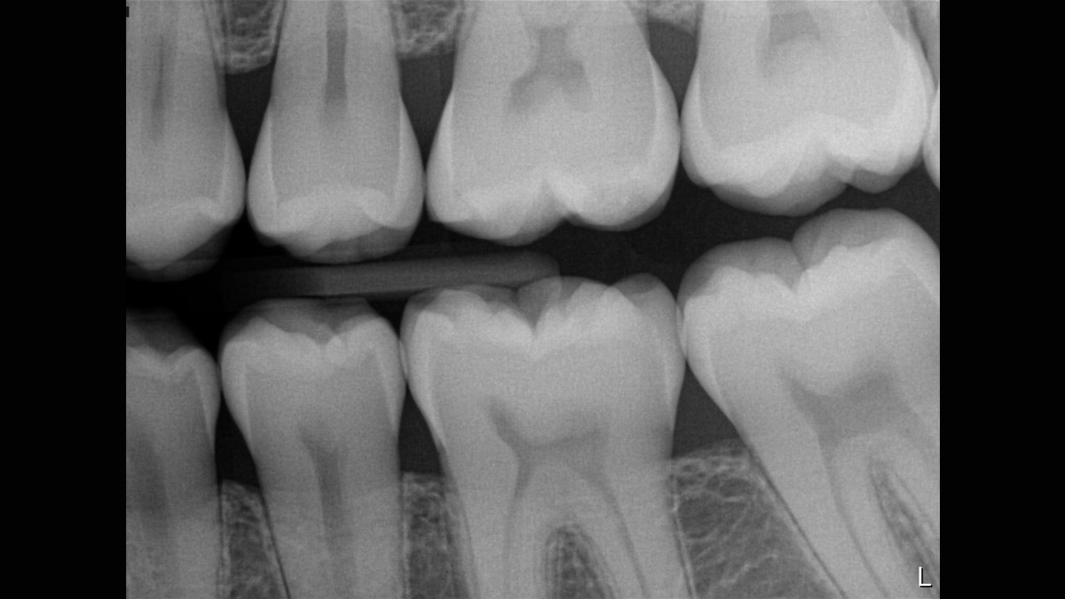 Xios XG Supreme Intraoral Sensor | Dentsply Sirona